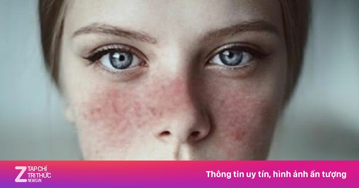 Bệnh lupus ban đỏ nguy hiểm thế nào? - Sức khỏe - ZNEWS.VN