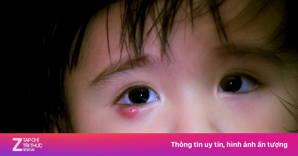 Chắp Lẹo Mắt Có Lây Không Bệnh Thường Gặp Znewsvn