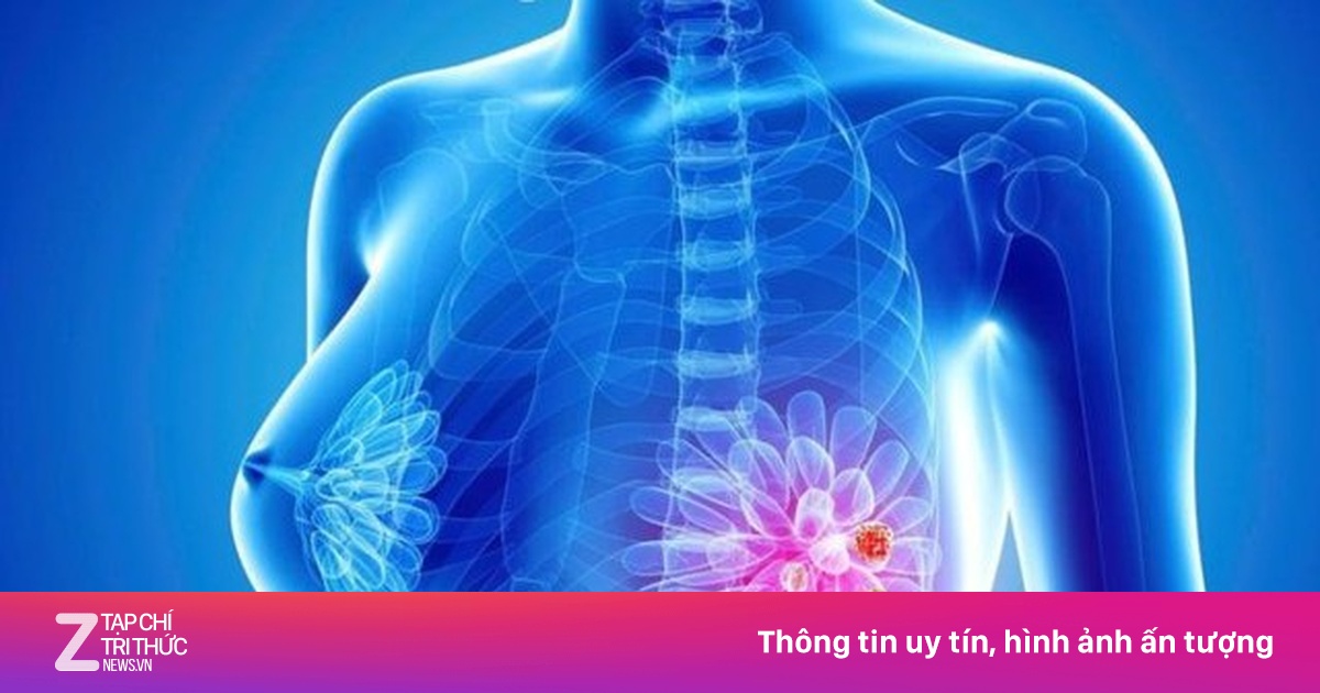 Bệnh nhân ung thư vú có nguy cơ bị ung thư buồng trứng không? - Bệnh ...