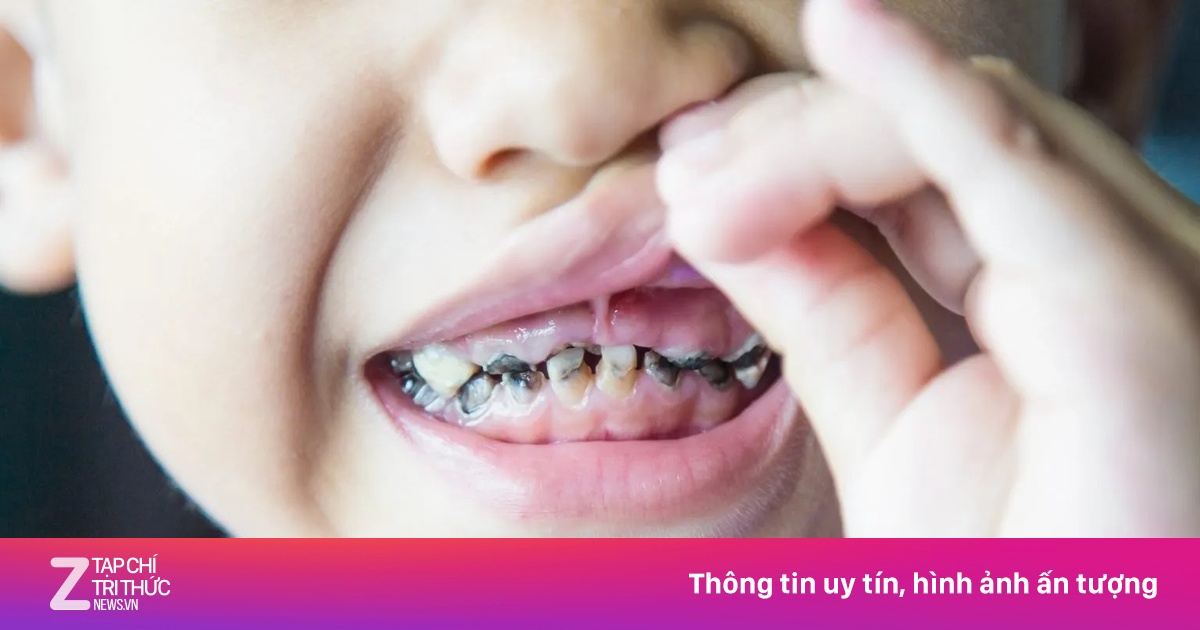 Lý do bất ngờ khiến trẻ con luôn bị sâu răng - Mẹ và Bé - ZNEWS.VN