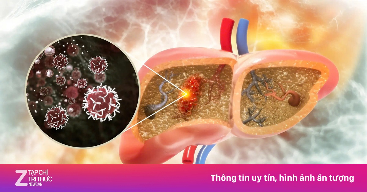 Cách 'tổ sâu' ung thư phá hủy lá gan | Znews.vn