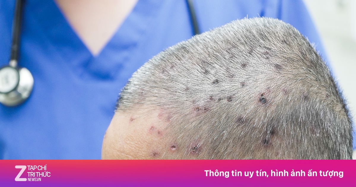 Gục ngã sau khi bị ong vò vẽ đốt 117 nốt khắp cơ thể | Znews.vn