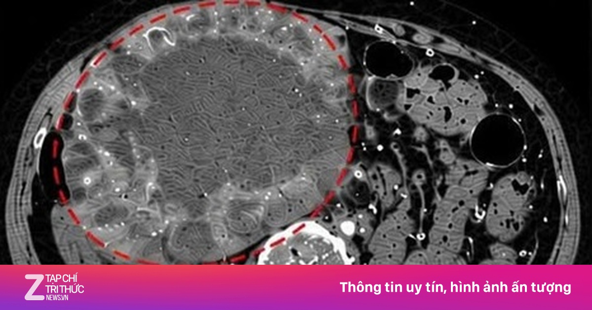 Vào viện với khối u gan 'khủng' vì một quyết định sai lầm | Znews.vn