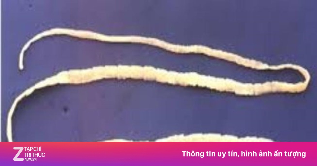 Sán xơ mít hơn 10 m làm ổ trong người - Sức khỏe - ZNEWS.VN