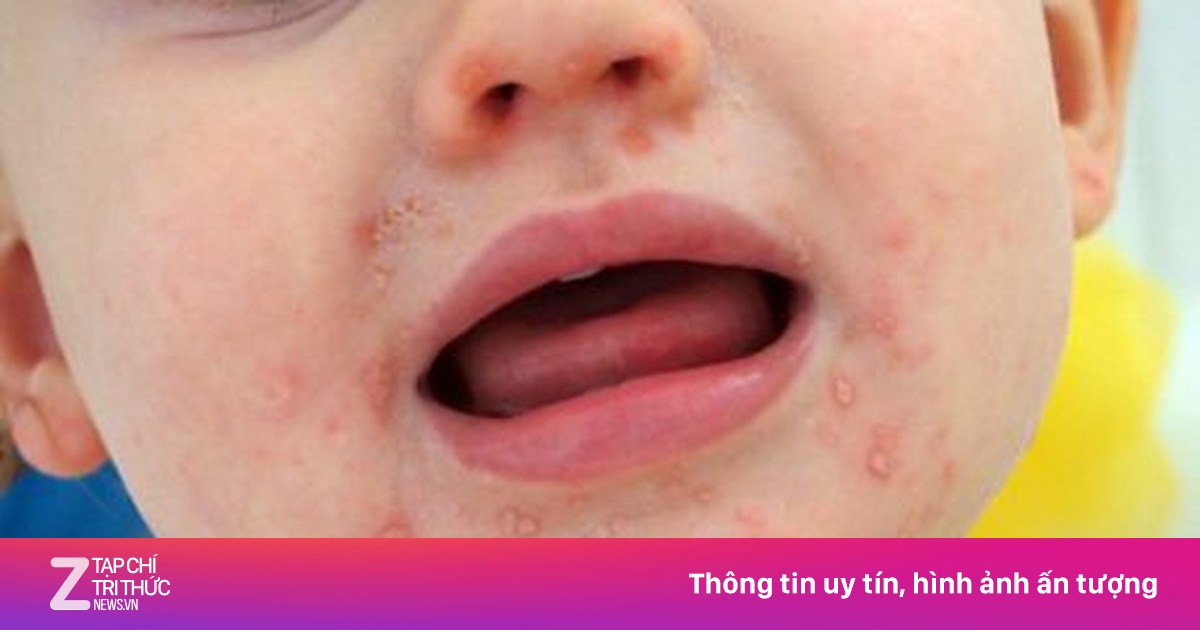 10 ca mắc tay chân miệng do nhiễm khuẩn EV71 tại Hà Nội - Sức khỏe - ZNEWS.VN