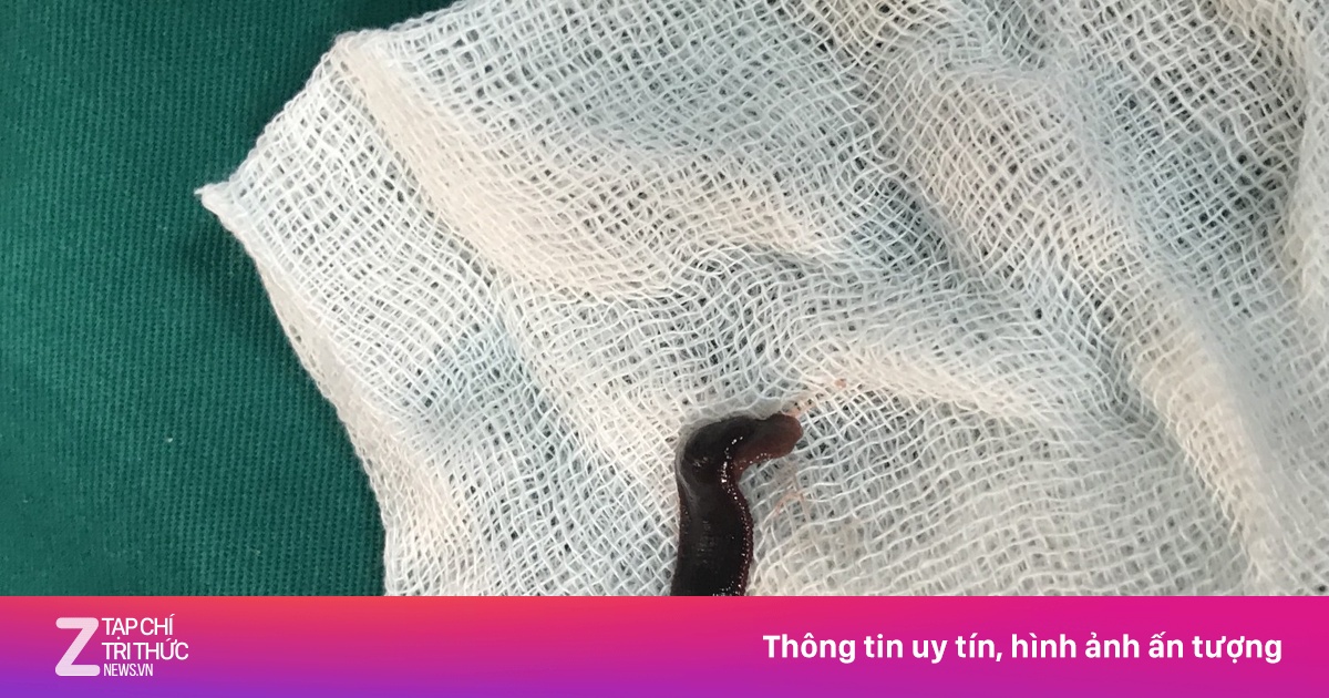 Con đỉa dài 5 cm trong mũi người phụ nữ sau khi uống nước suối - Sức ...