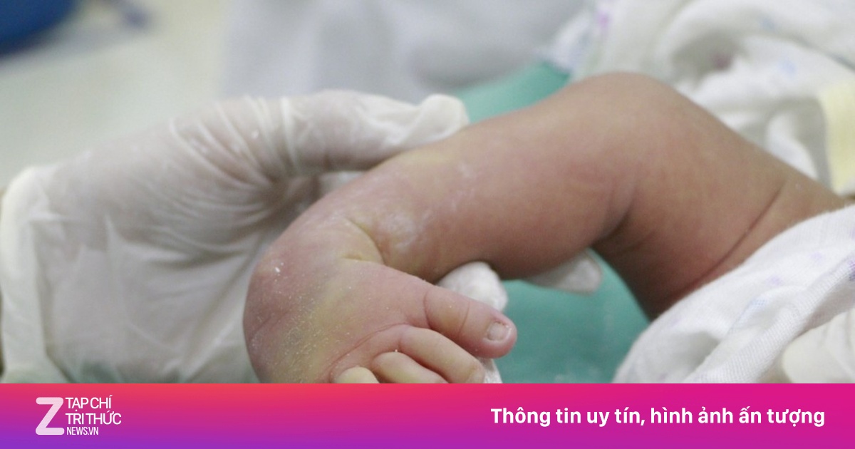 Phục hồi bàn chân cho bé trai bị khoèo bẩm sinh | Znews.vn