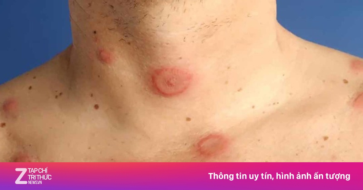 Biểu hiện của lupus ban đỏ - Sức khỏe - ZNEWS.VN