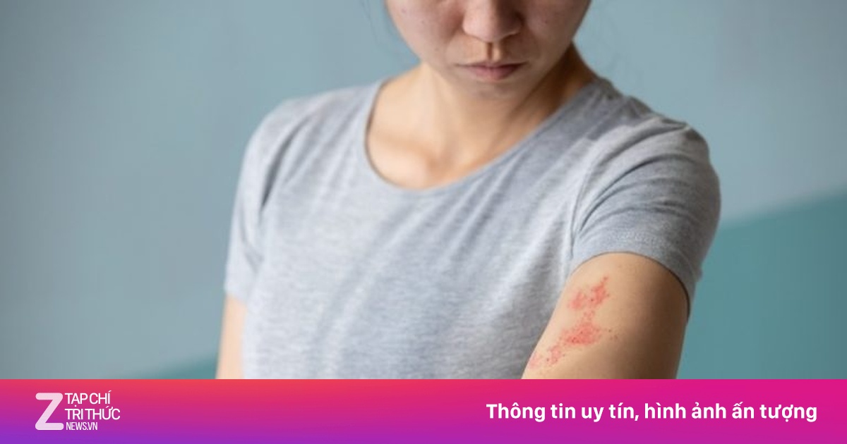 Giời leo là bệnh gì? | Znews.vn