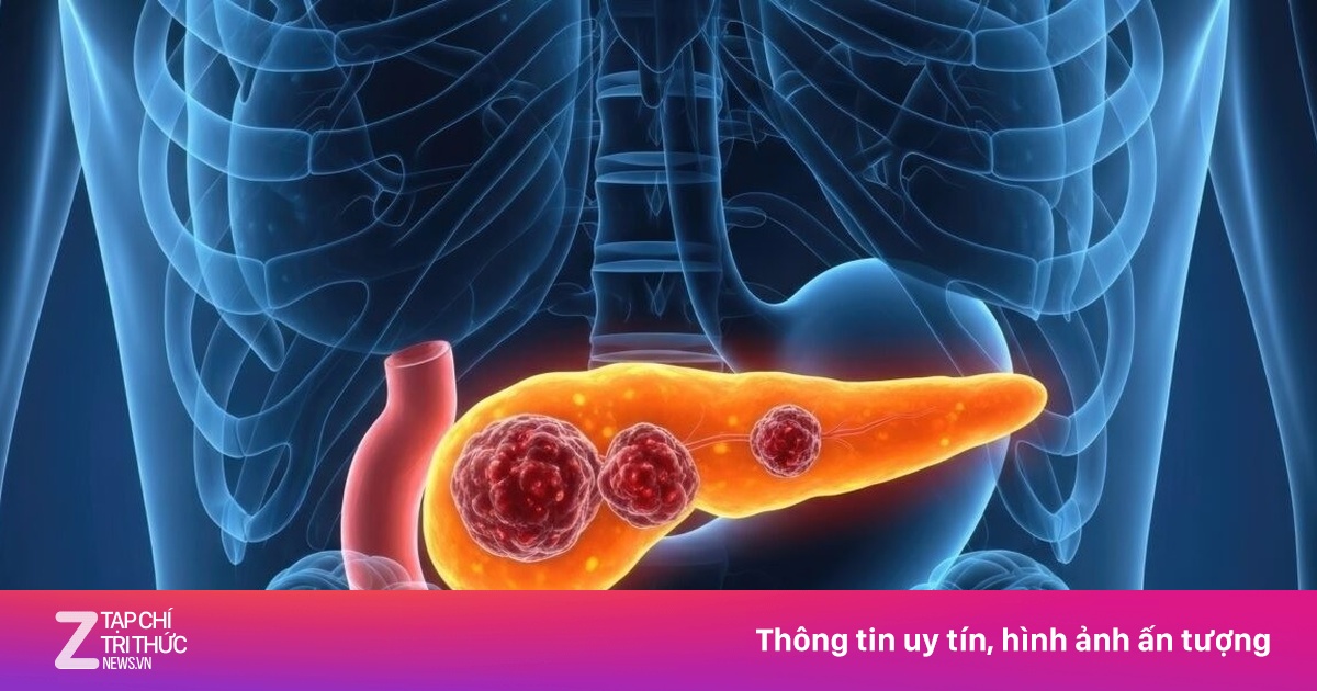 4 dấu hiệu âm thầm cảnh báo sớm ung thư tuyến tụy | Znews.vn