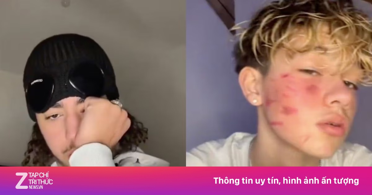TikTok bị điều tra vì thử thách độc hại ‘French scar’ - Internet - ZNEWS.VN